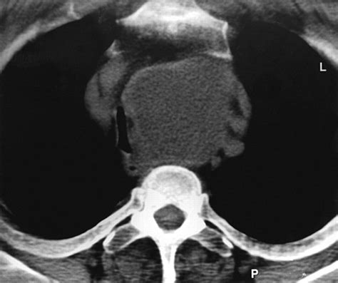 Thyroid Disease British Journal Of Anaesthesia