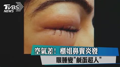 空氣差 櫃姐鼻竇炎發 眼腫變「鹹蛋超人」 Youtube