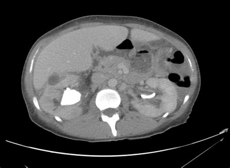 14 Pyelo Differential Diagnosis Of