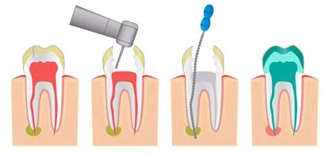 Bocadillo Alérgico traidor proceso endodoncia dental frecuentemente Mono Promover