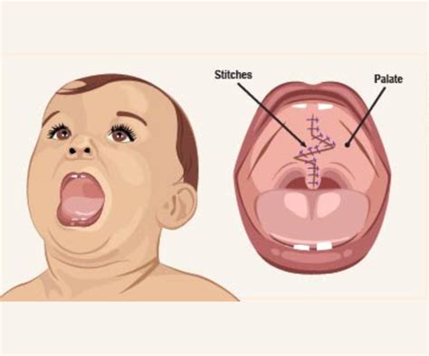 Cleft Palate Speech Therapy House