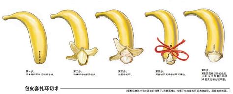 The Correct Procedure For Banana Circumcision Wtf