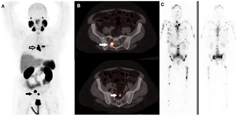 Pet And Spect Imaging In Prostate Cancer Encyclopedia Mdpi