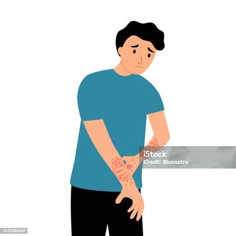 손과 팔을 긁는 청년 강한 알레르기로 고통받는 사람은 평평한 디자인에서 가려운 피부 가려운 증상입니다 붉은 발진 피부 자극 모기에 대한 스톡 벡터 아트 및 기타 이미지