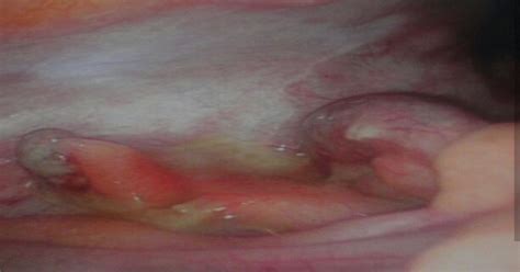 Heres A Photo Of My Appendix When I Had Appendicitis Mildlyinteresting