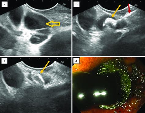Technique Of Endoscopic Ultrasound Guided Choledochoduodenostomy