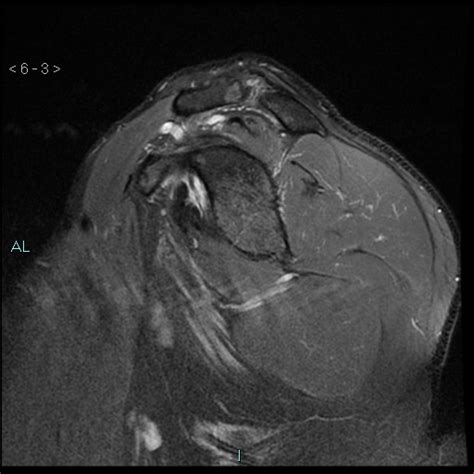 Radiopaedia Case Rotator Cuff Tear Long Head Of Biceps Tendon