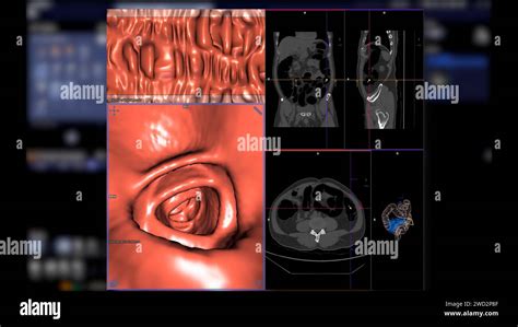 Ct Colonography This Imaging Technique Is Often Employed For