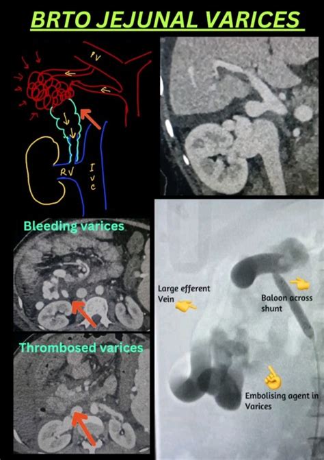 [video] Dr Amrin Ir On Linkedin Savinglives Varices Cirrhosis Malena Brto Embolization