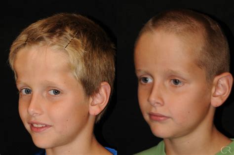 Metopic Suture Craniosynostosis