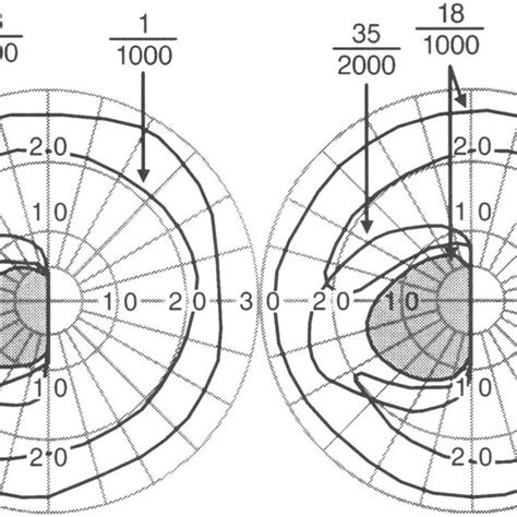 Pdf The Four Meter Confrontation Visual Field Test