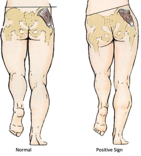 Msk Tests Flashcards Quizlet