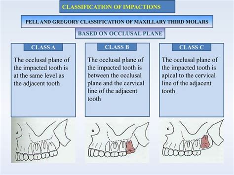 Impaction Pptx Dental Health Diseases And Conditions