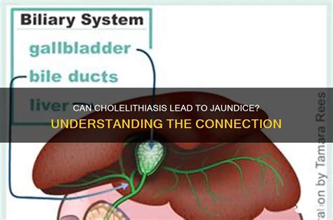 Can Cholelithiasis Lead To Jaundice Understanding The Connection Medshun