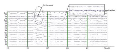 Example Of An Eeg Signal Contaminated With Noise Download Scientific