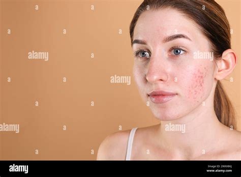 Young Woman With Acne Problem On Beige Background Space For Text Stock