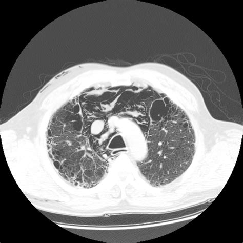 Radiopaedia Case Combined Pulmonary Fibrosis Emphysema Syndrome