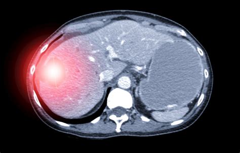 Hepatic Cyst Giant Hepatic Cyst Determining Secondary Budd Chiari