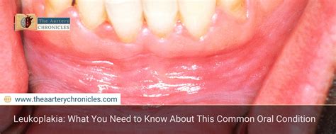 Leukoplakia What You Need To Know About This Common Oral Condition