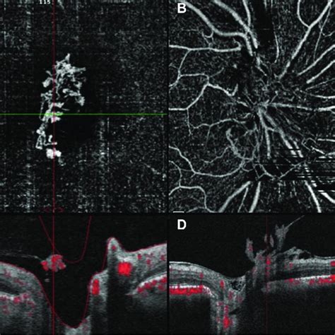 Oct Angiograms Of Pdr Treated With Laser Photocoagulation Left Column