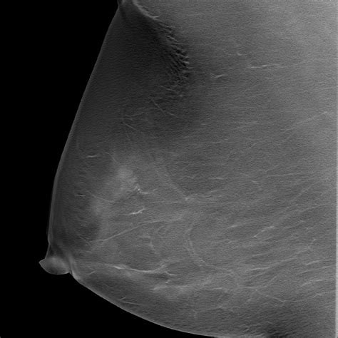 Microcalcification In Dbt Object Detection Dataset By Uitm