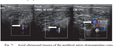Figure 2 From Parameniscal Cyst A Rare Cause Of Popliteal Artery