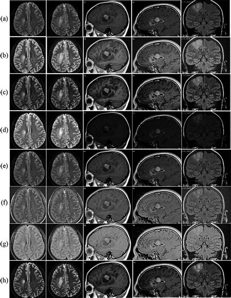 Results Comparison Of Glioma Images Enhancement A Original B Download Scientific Diagram