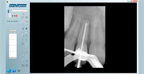 Radiografia E Imagem Sensor Digital Eagle S Tamanho 2 Peixoto
