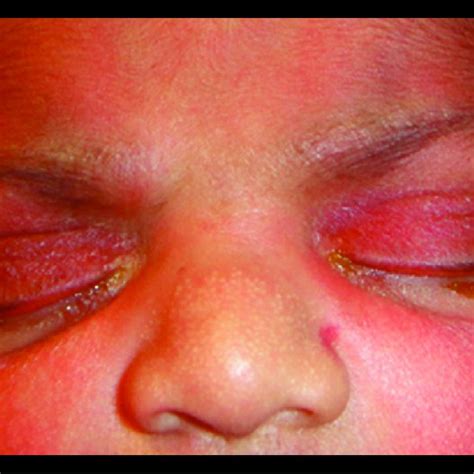 The Graft Is Positioned With The Perichondral Side Facing Internal So