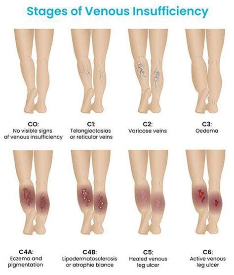 Stages Of Venous Insufficiency Medizzy