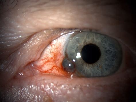 Konjunktivalt Malignt Melanom Ugeskriftetdk