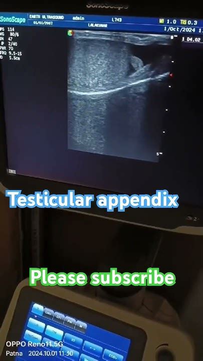 Usg Of Scrotum Ultrasound Usg Hydrocele Testicularappendix Scrotum Youtube