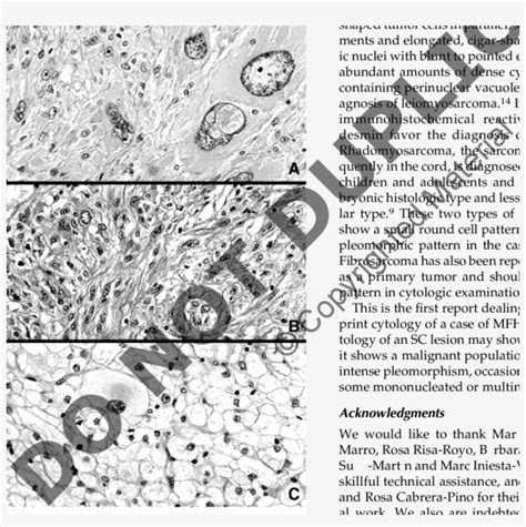 Neoplastic Proliferation Of Atypical Cells With High Zellballen