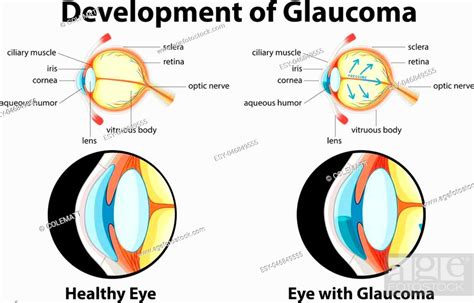 Diagram Showing Development Of Glaucoma Illustration Stock Vector