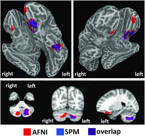 Brain Entropy Regression Comparison With Spm Wasi Estimated Iq Whole