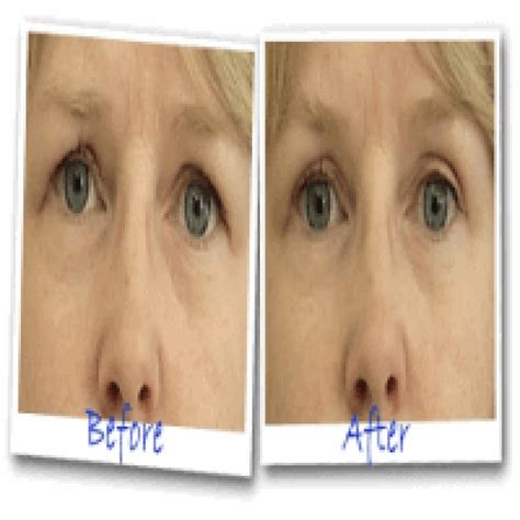 Best Droopy Eyelid Fix No Surgery Eye Secrets Eyelid Lift Yummylooks