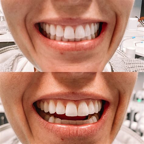 Teeth Before And After Invisalign