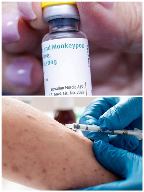 Mpox Outbreak Know Causes Symptoms And Treatments MyNation