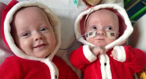 One Identical Twin Born Almost Double The Size Of The Other