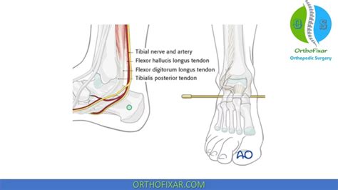 Skeletal Traction Femur Fracture
