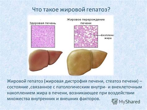 Презентация на тему Жировой гепатоз болезнь или следствие наших