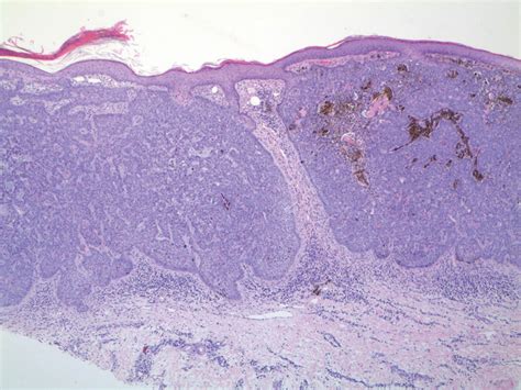 Collision Course Of A Basal Cell Carcinoma And Apocrine Hidrocystoma On