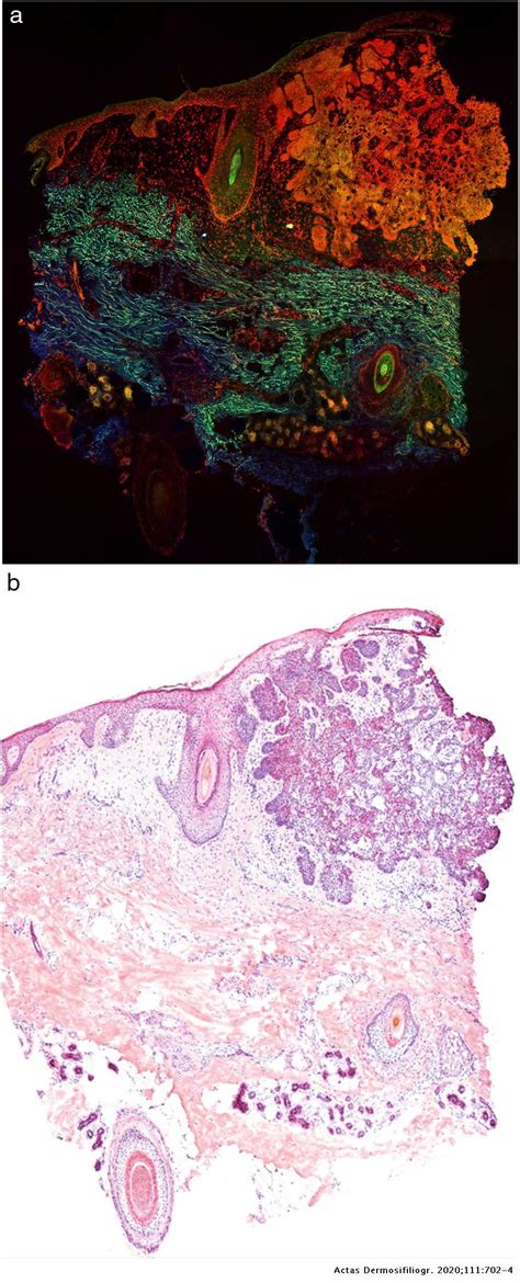 Ex Vivo Fluorescence Confocal Microscopy On A 3 Color Scale A New
