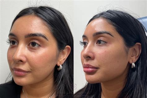 Dermal Fillers Before And After Pictures Case 683 Houston Tx