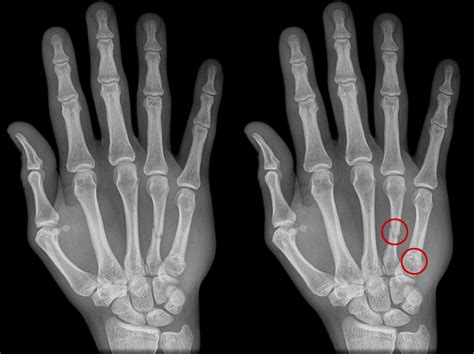 Trauma X Ray Upper Limb Gallery 2 Hand Boxers Fracture