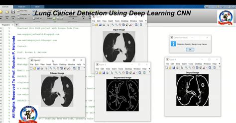 Lung Cancer Detection Using Deep Learning Cnn Matlab Project With