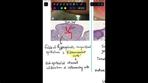Papillae Vs Follicles In Conjunctiva Histopathology Shorts Youtube