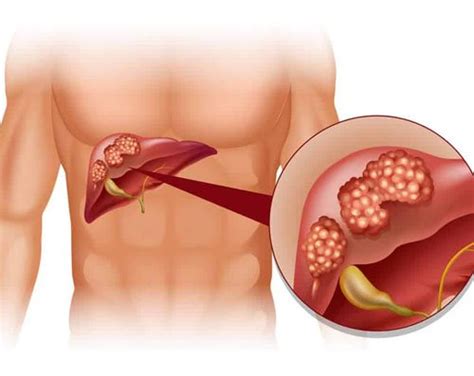 Best Liver Cysts Treatment In Delhi Dr Mohit Jain