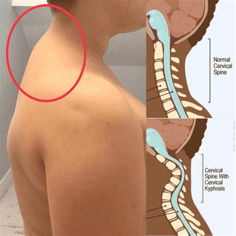 A Guide To Know About Cervical Kyphosis Spine Surgeon
