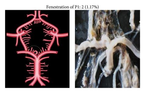 P1 Fenestration Dotted Circle Shows The Fenestrated P1 Segment